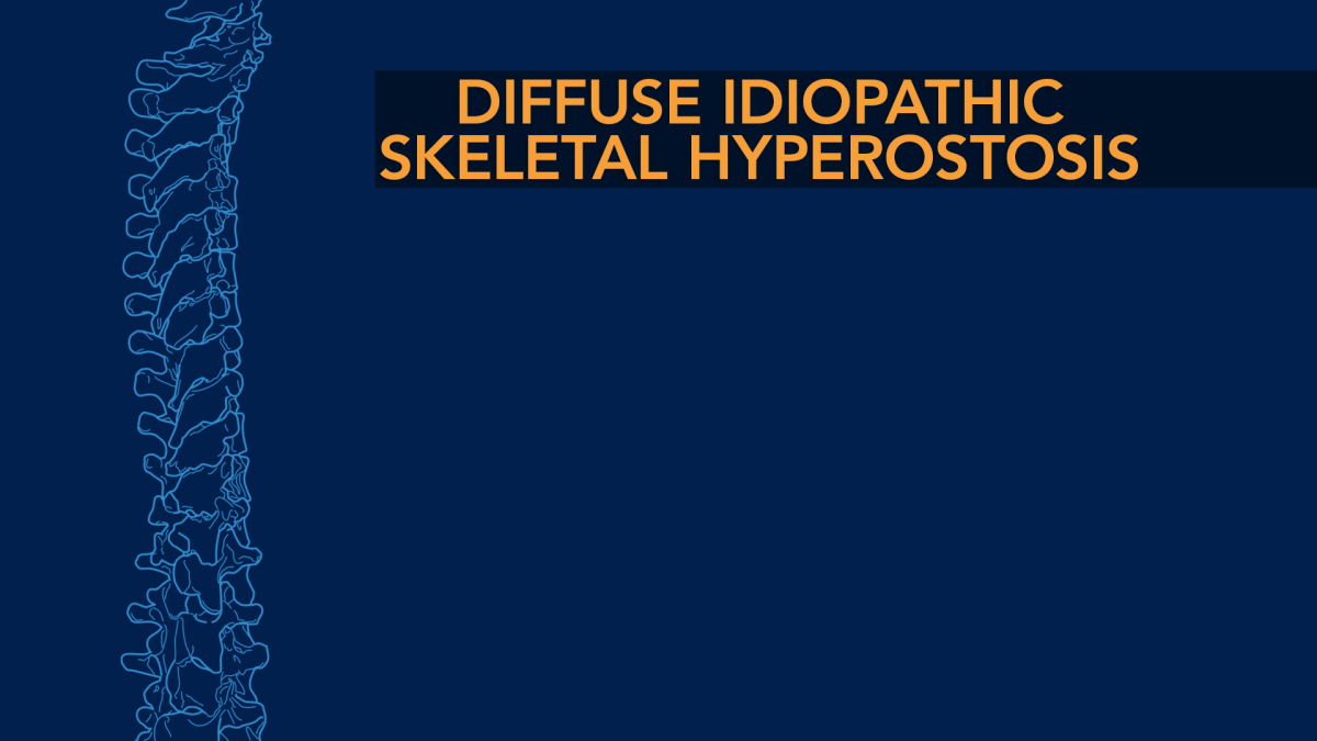 Diffuse Idiopathic Skeletal Hyperostosis (DISH) - The Spine Community